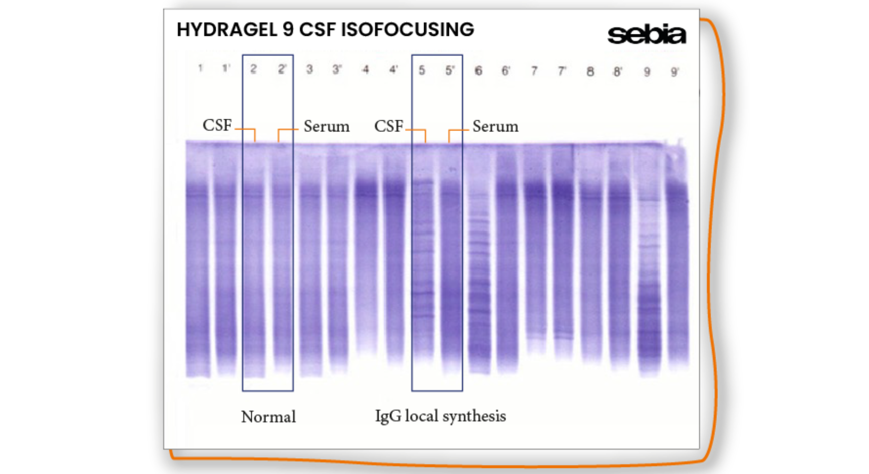 Oligoclonal bands detection in CSF